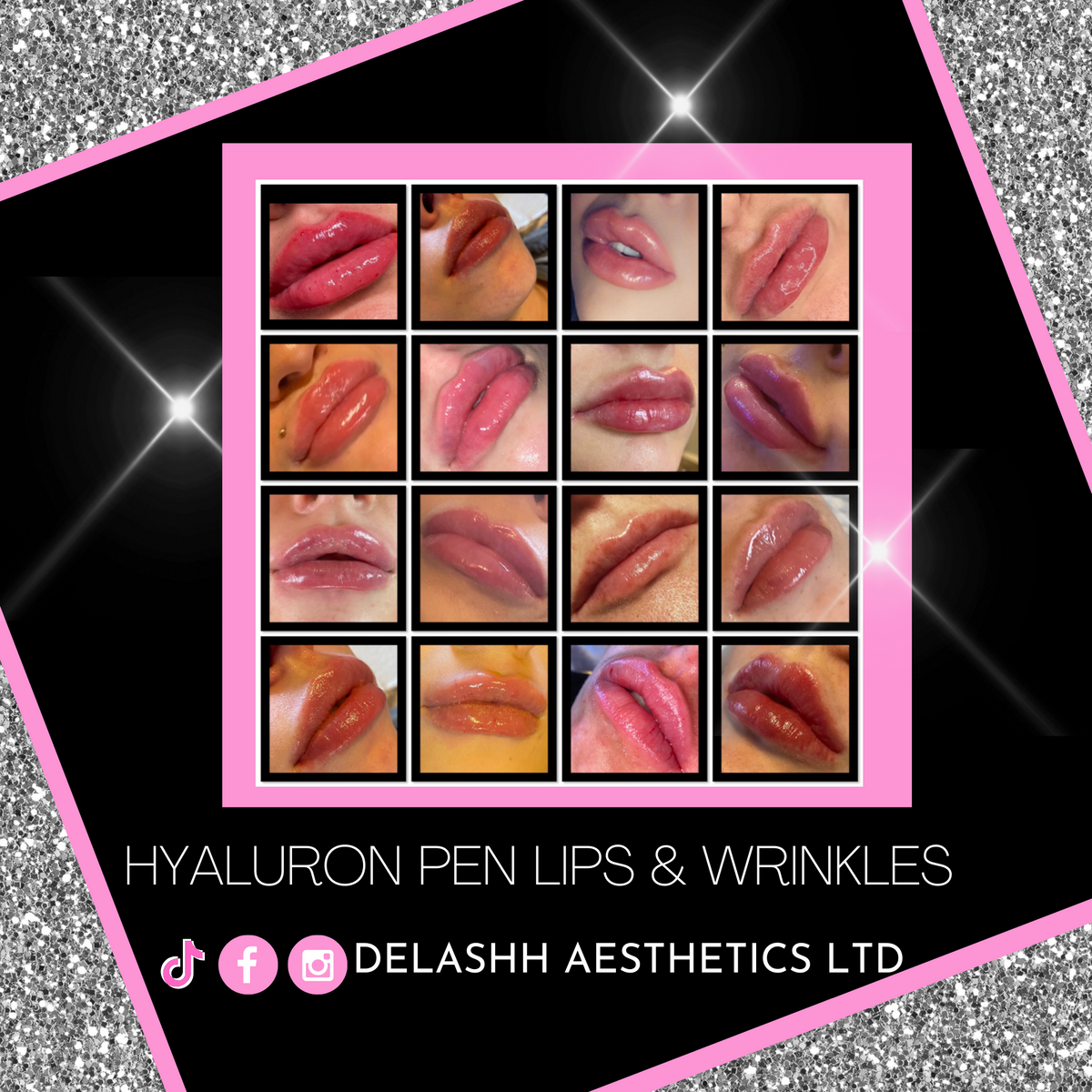 Hyaluron Pen: Lips & Wrinkles – Delashh Aesthetics & Training Limited